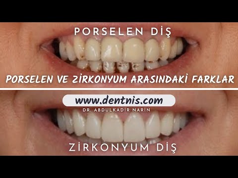 Porselen Kaplama ve Zirkonyum Kaplama Arasındaki Fark Nedir?