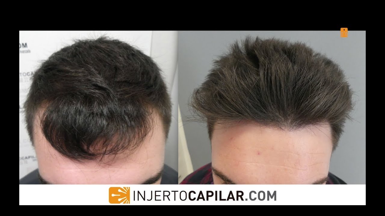 601 FUE Grafts in a NW IIvertex, 8 years after. in a very young patient ...