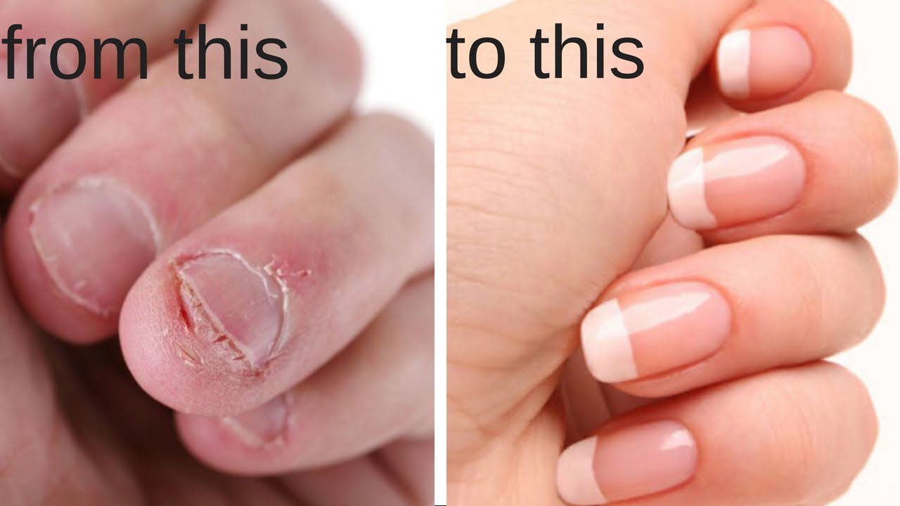 How To Stop Biting Your Nails Break The Habit Permanently YouTube How To Stop Biting Your Nails Break The Habit Permanently YouTube