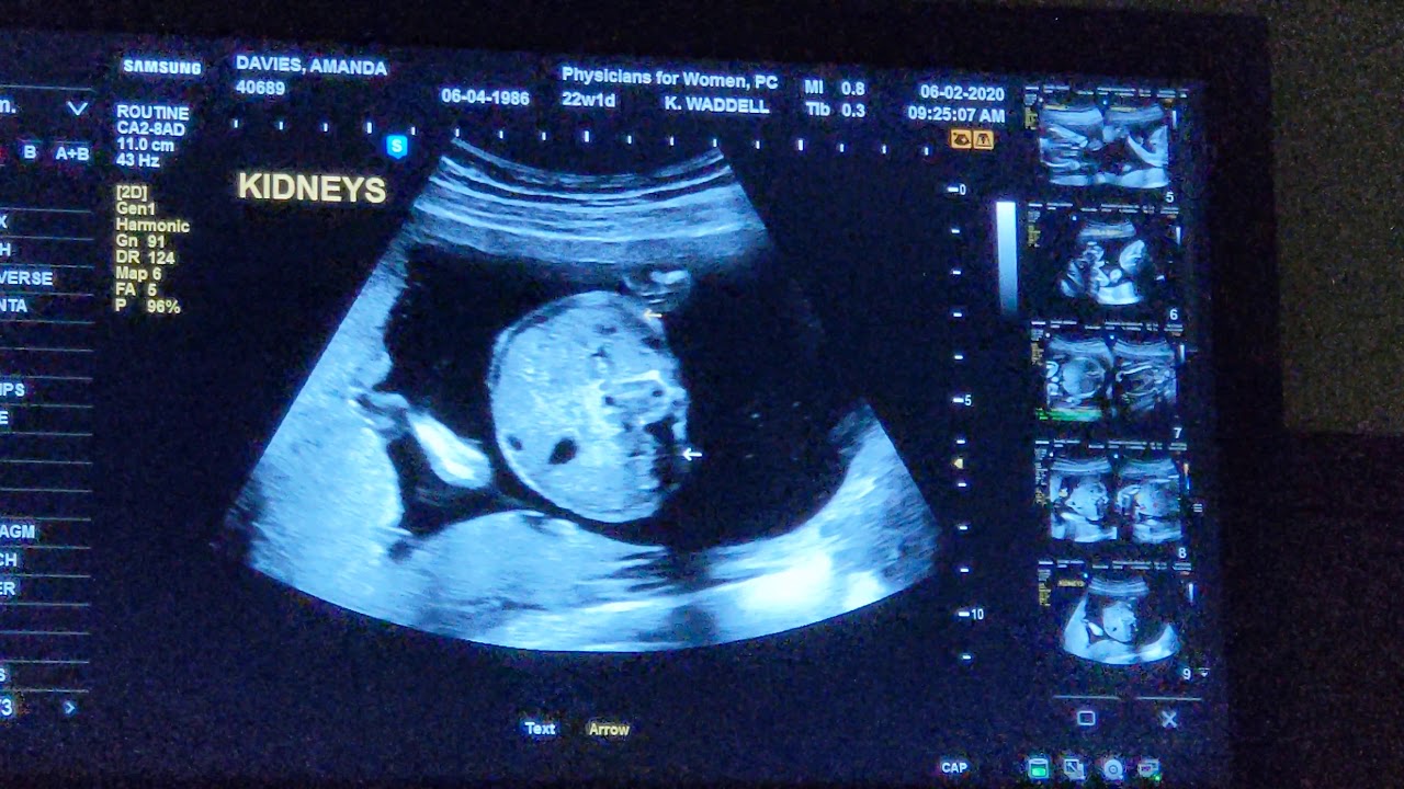 22 Week Gender and Anatomy Scan! - YouTube