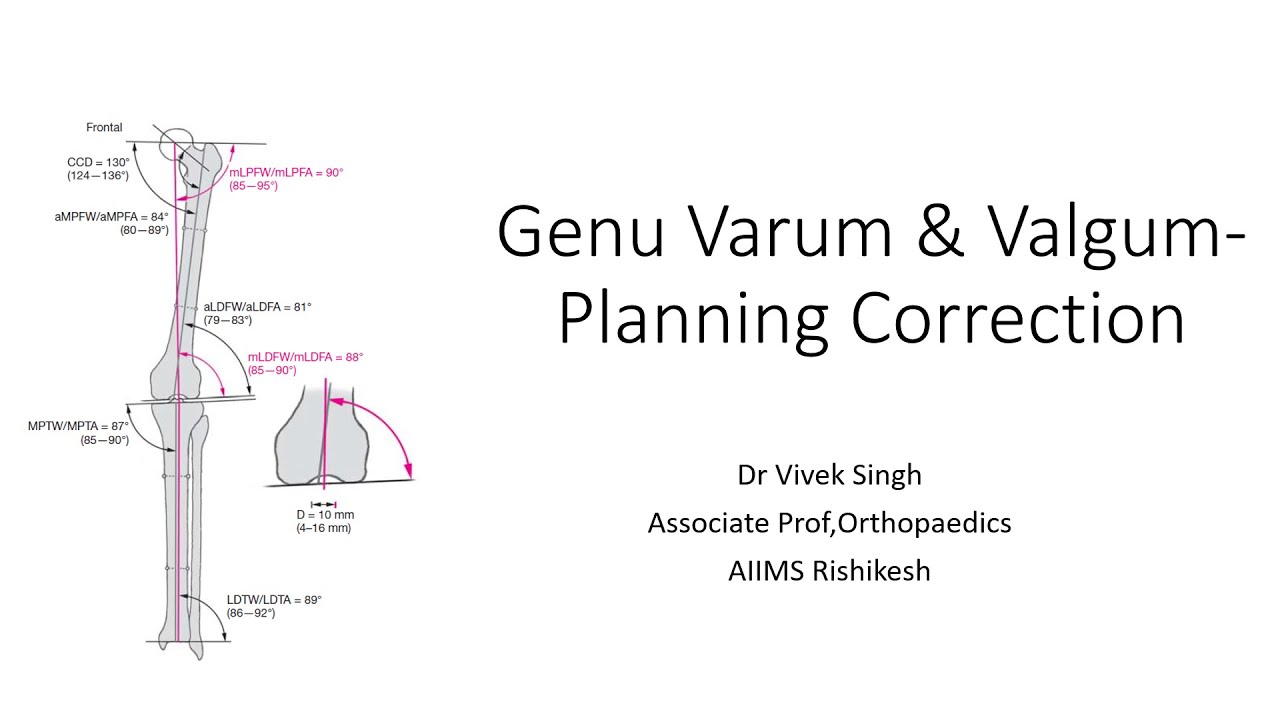 Singh's Ortho Insights-Genu varum & valgum-Planning correction - YouTube