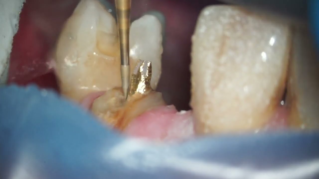 Dentatus Screw Post Removal - YouTube