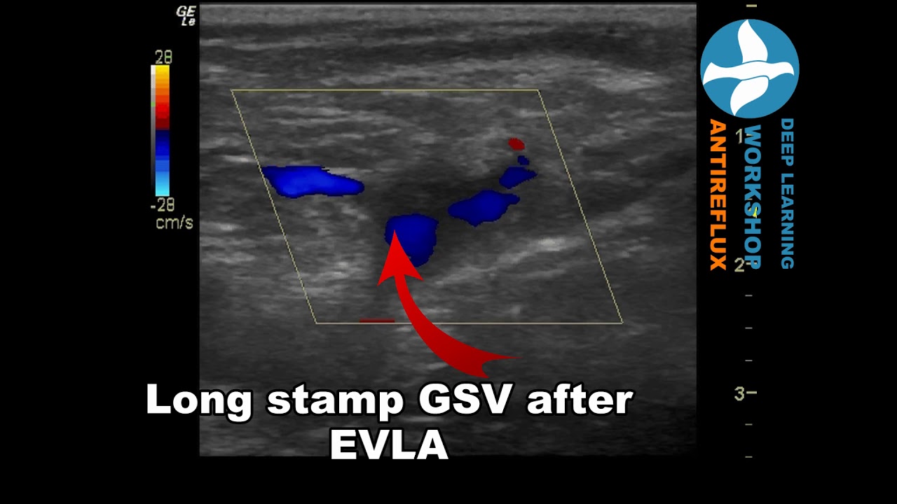 Long stamp GSV after EVLA - YouTube