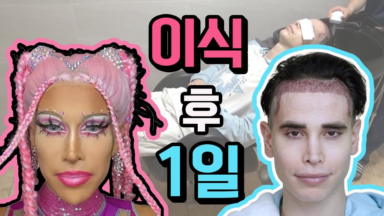 [비절개모발이식]틱톡(Tiktok) 43만(430K)인플루언서 ‘Santi Storm’ 모발이식 1일 후 - YouTube