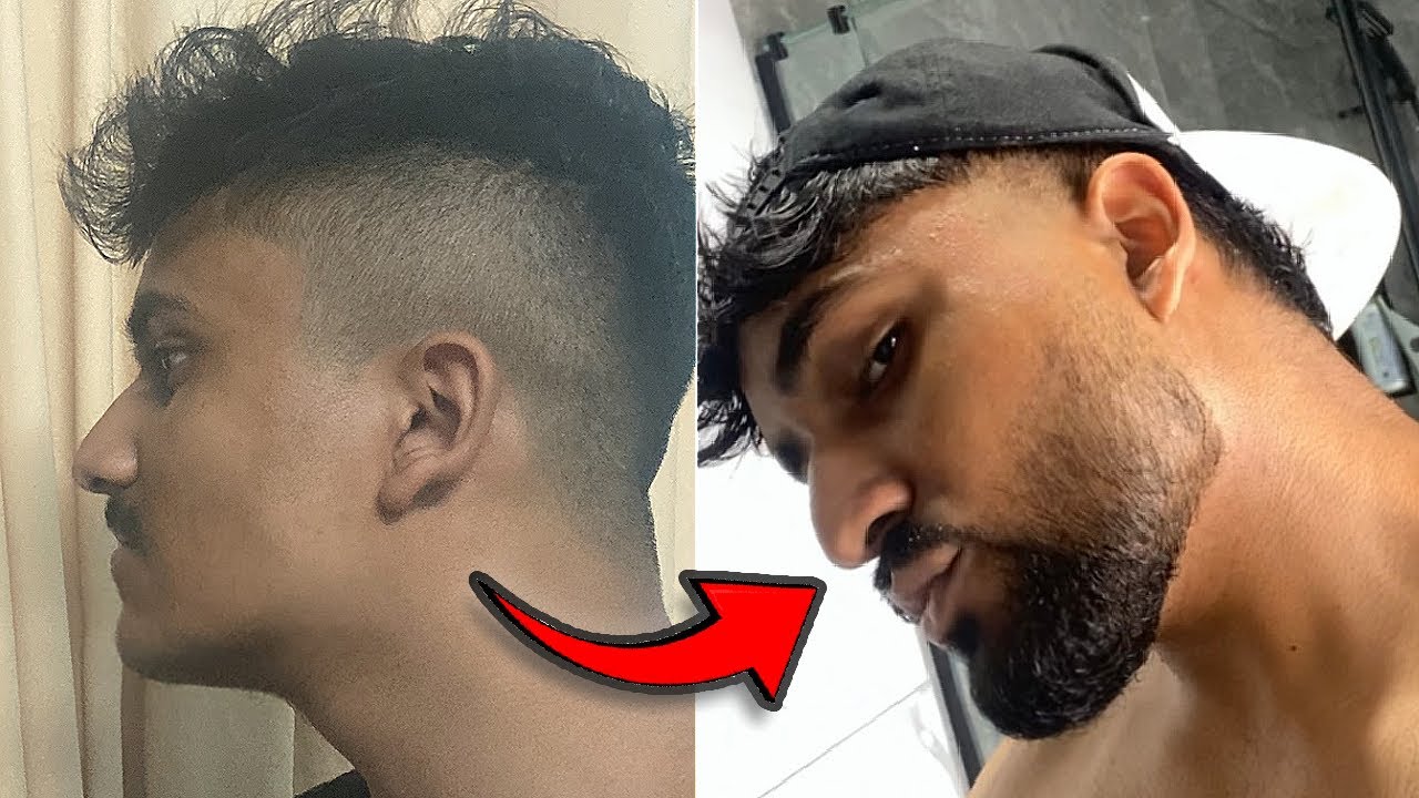 How I Fixed My Receding Chin - YouTube