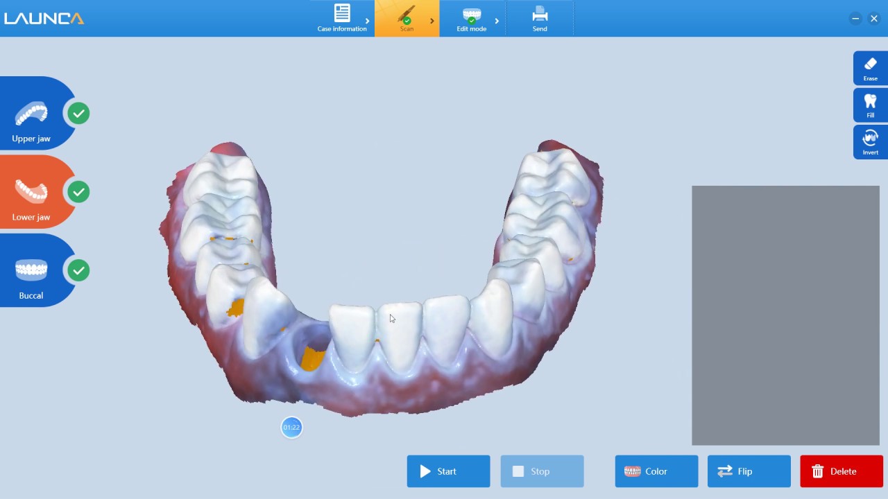 High accuracy with True color by Launca Intraoral scanner - Denstagenie ...
