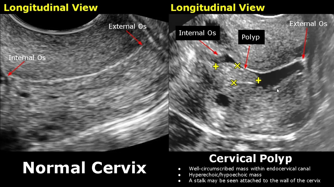 Cervix Ultrasound Normal Vs Abnormal Image Appearances Uterus Cervix Ultrasound Normal Vs Abnormal Image Appearances Uterus
