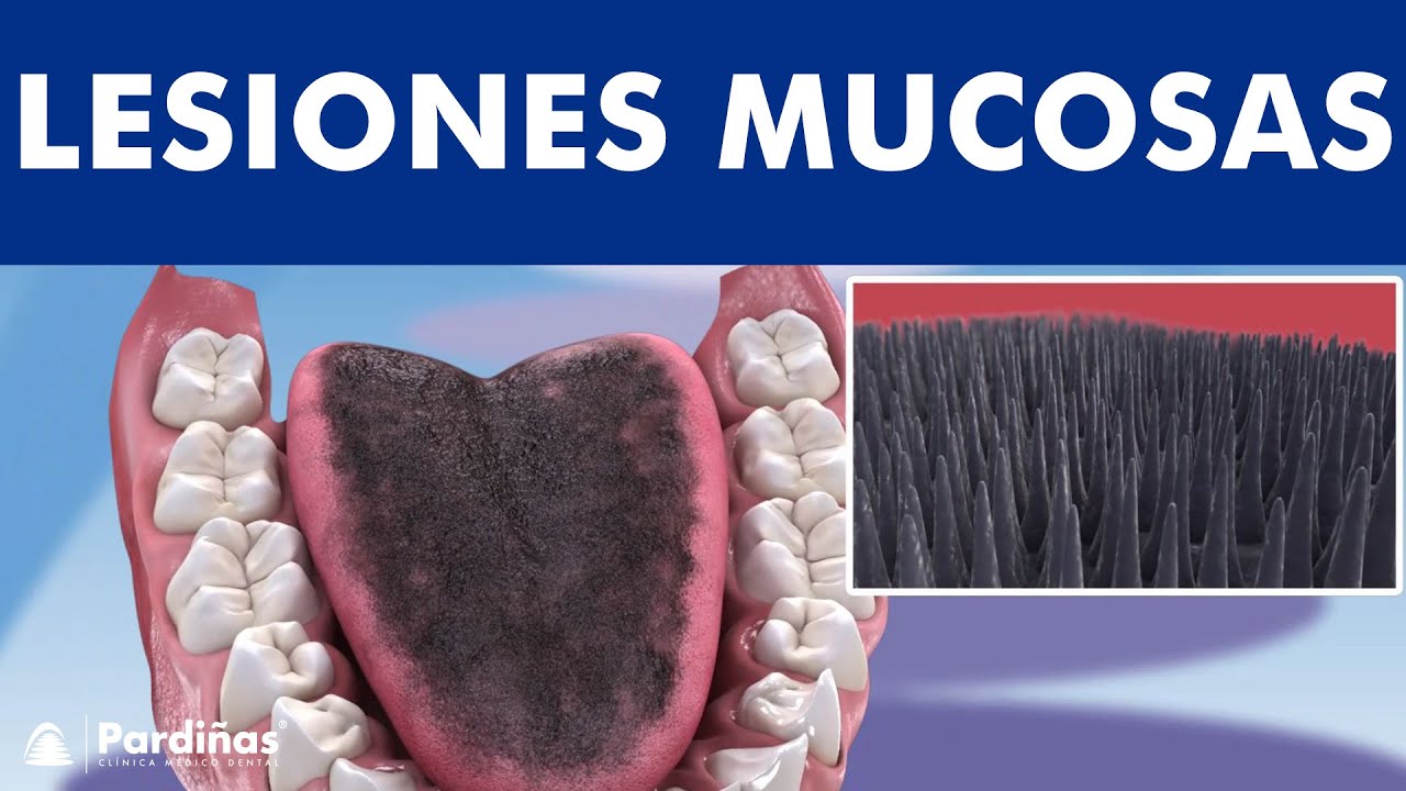 Lengua geográfica, liquen plano, leucoplasia y otras lesiones de mucosa ...