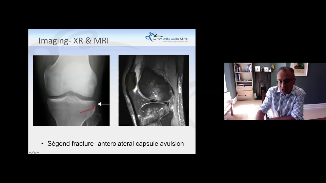 May 2020: "The Ruptured ACL" Child to Adult and OA Knee Evidence Based ...
