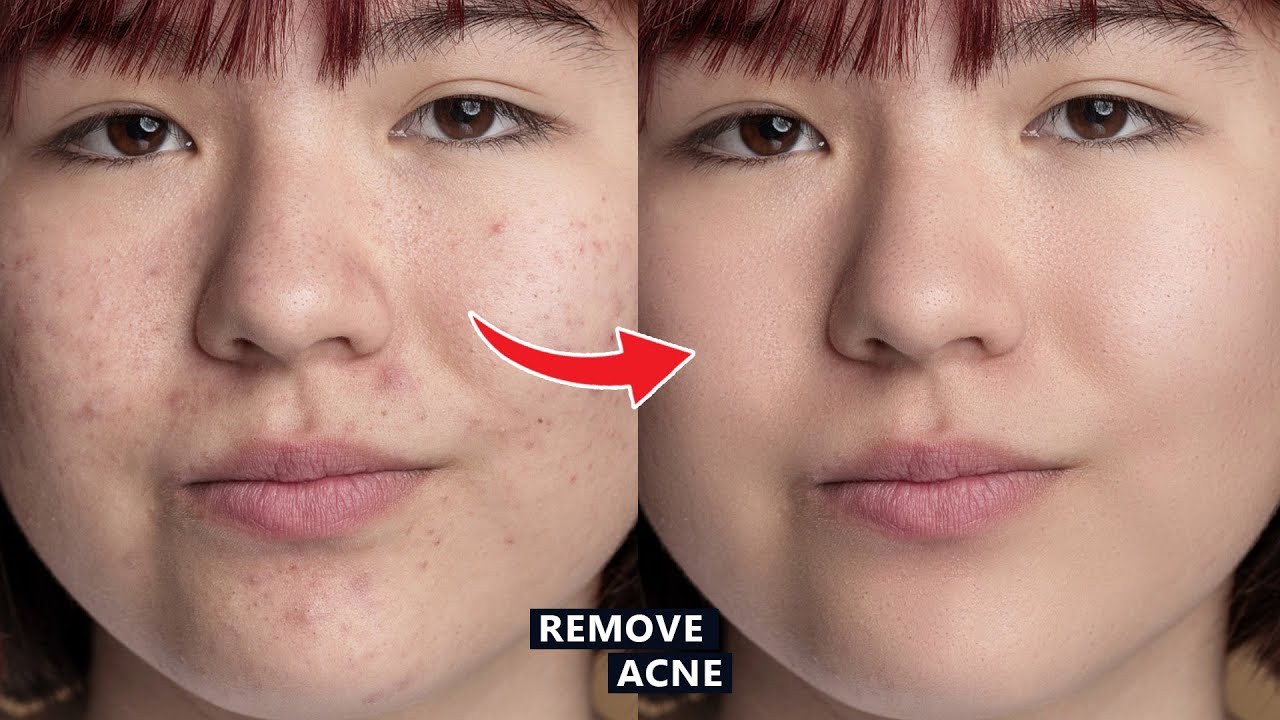 How to Remove Acne in Adobe Photoshop Tutorial for beginners - YouTube