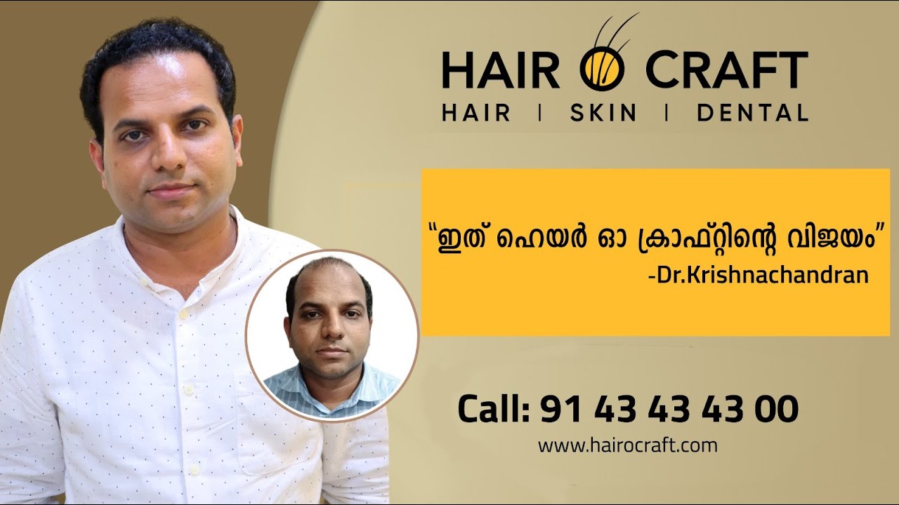 8 Months Result | My Hair Transplantation Journey | Hair O craft | Dr ...