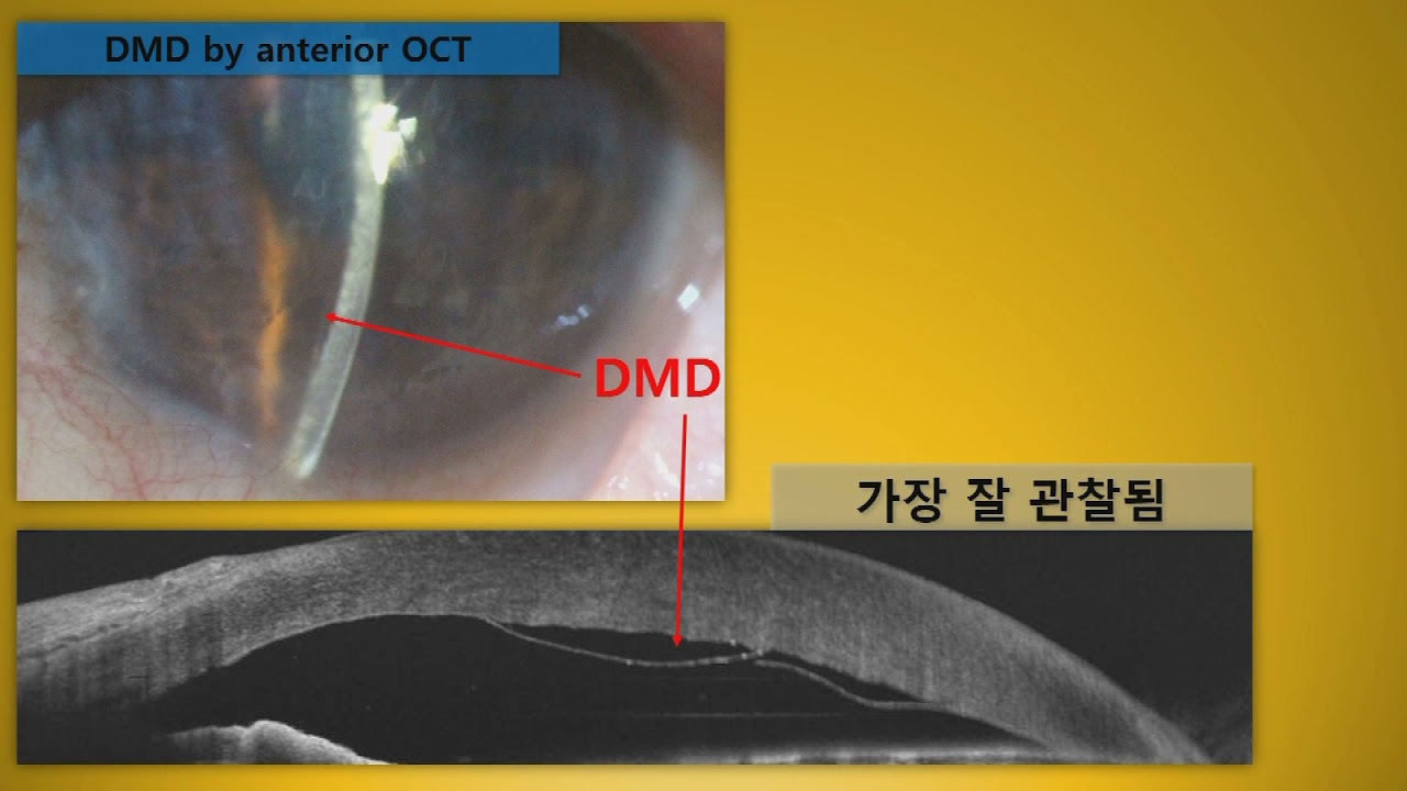 V-003 Descemet membrane detachment during cataract surgery - YouTube