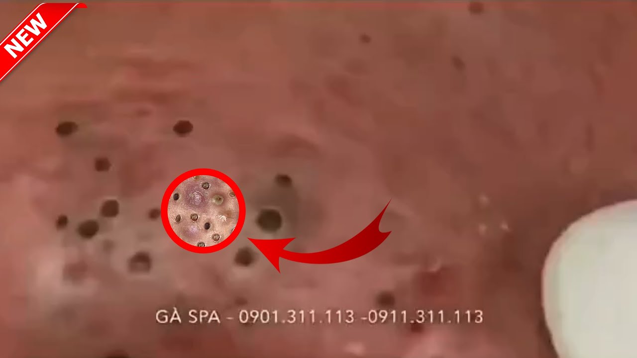 Blackheads Removal | Acne Treatment and Very Satisfying Satisfying ...