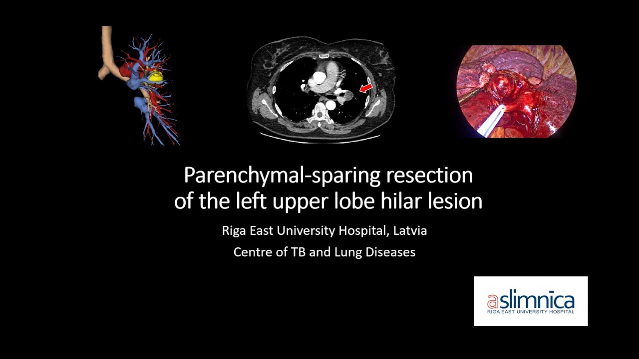 Parenchymal-sparing resection of the left upper lobe hilar lesion ...