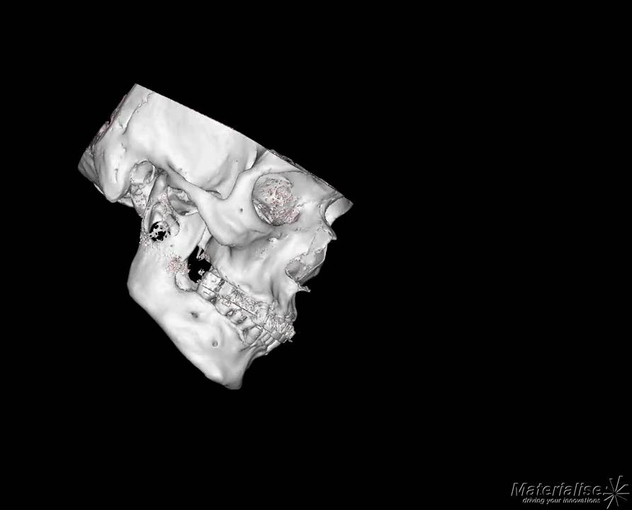 Maxillofacial - 3D medical model - Mandibular cyst - 260109 - YouTube