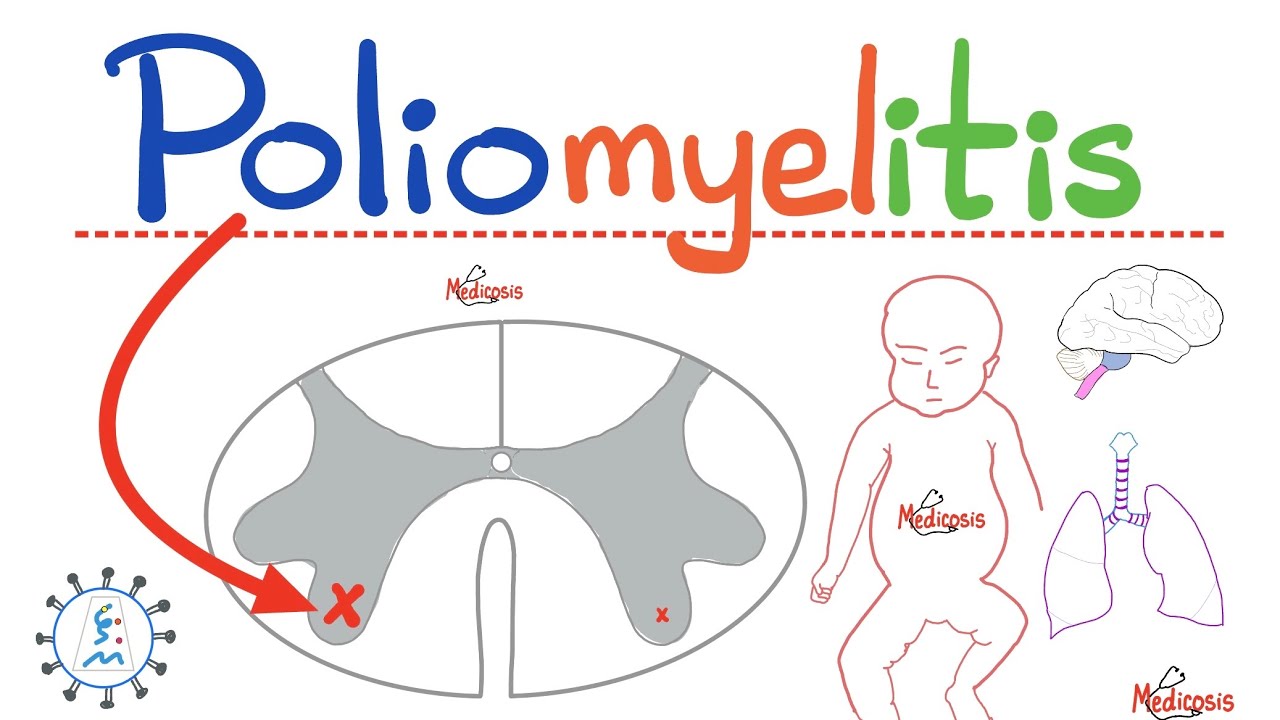 Poliomyelitis - Paralysis - Anterior Horn Cell (AHC) disease- Hypotonia ...