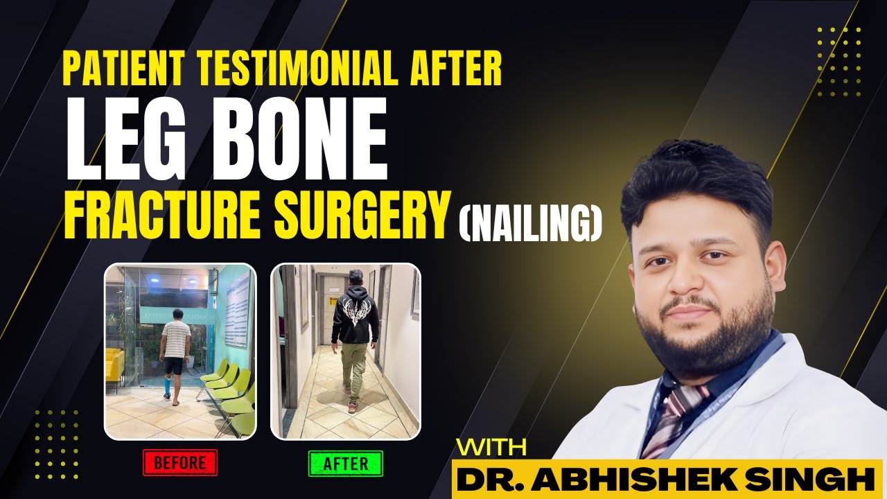 Recovery Journey of a 4-Piece Leg bone Fracture (1 vs. 3 Months) - YouTube