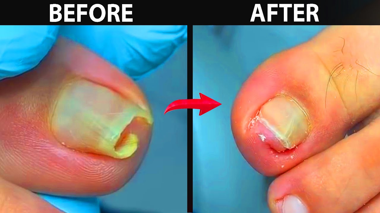 HOW TO REPAIR CURLED NAIL|ASRM - YouTube