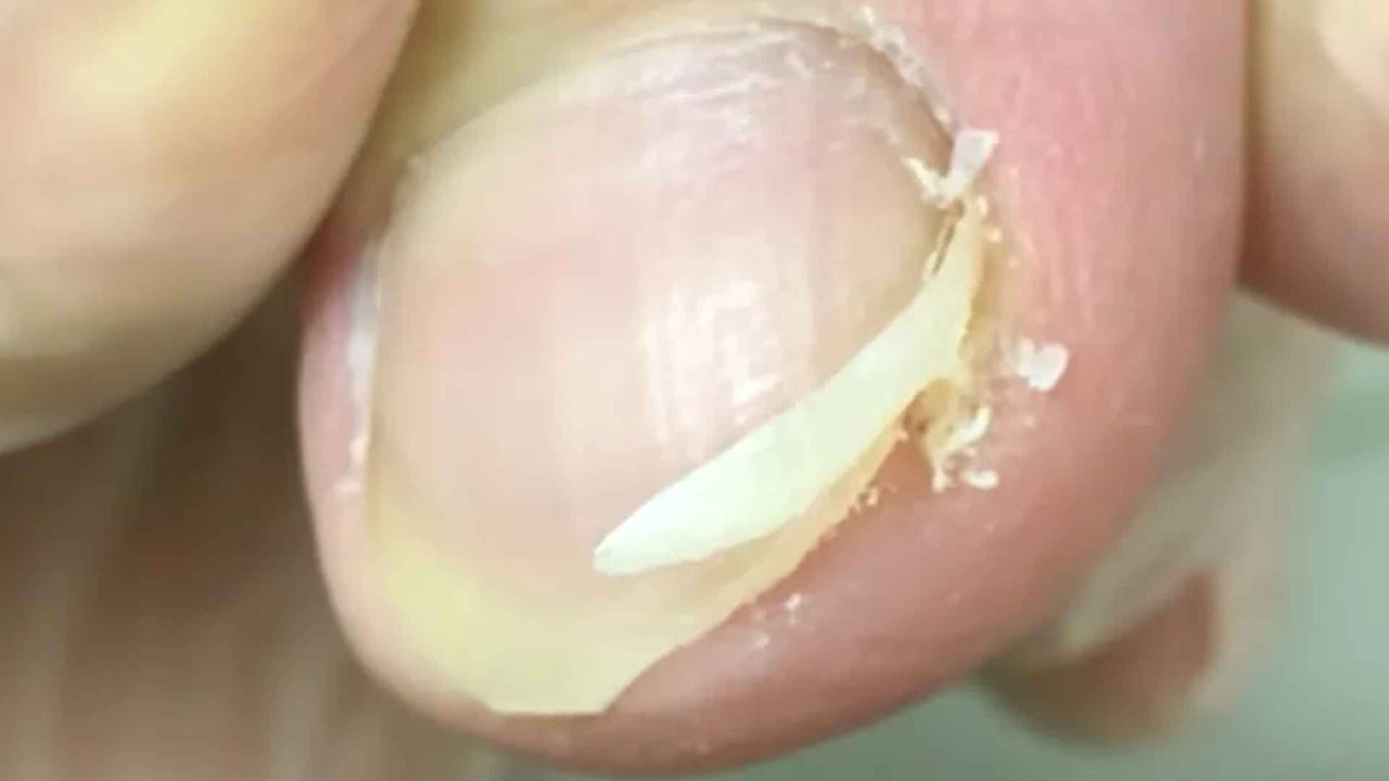 Trim extra deep ingrown nails on both sides【Dr. Zhang】 - YouTube