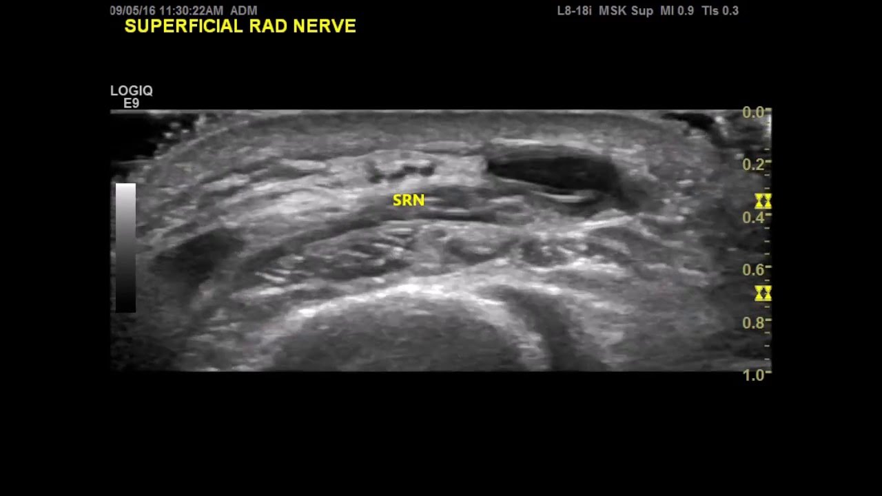 Course of radial nerve in the forearm - YouTube