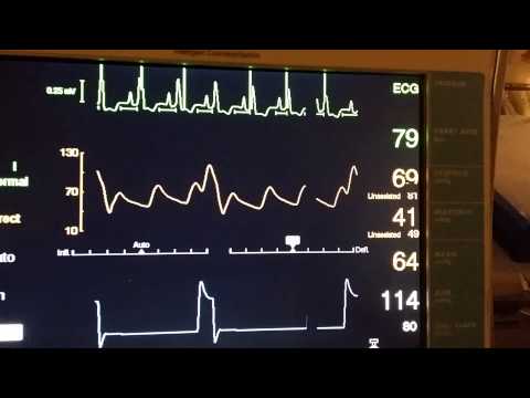 IABP 1:1, 1:2, 1:3 - YouTube