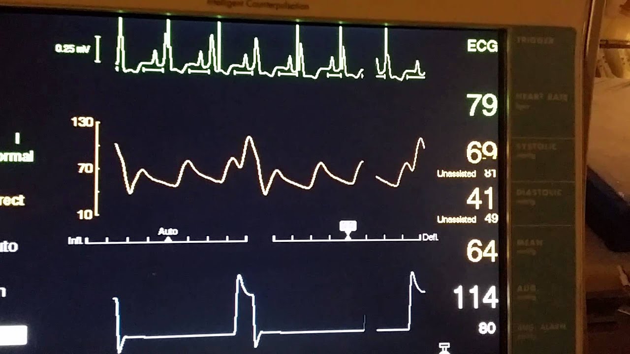 IABP 1:1, 1:2, 1:3 - YouTube