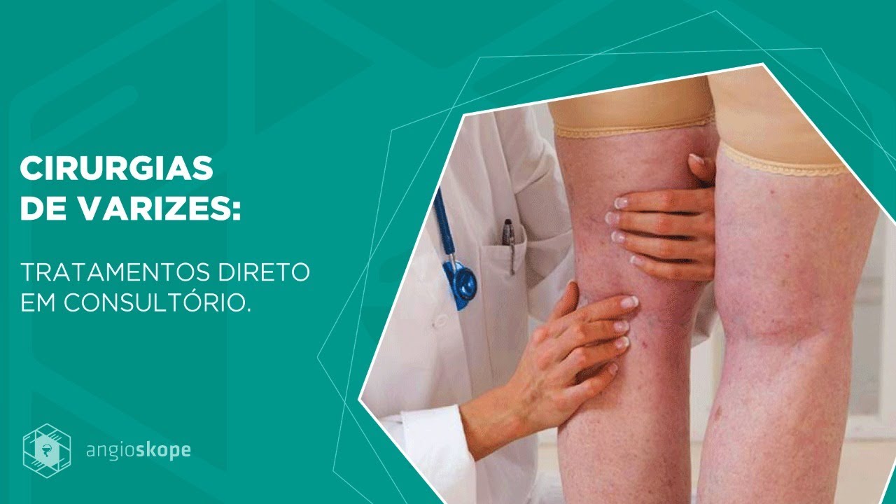 VARIZES - Cirurgias direto no consultório - Clínica Angioskope - YouTube