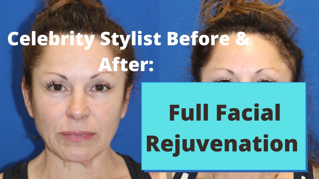 Celebrity Stylist Received Full Face Rejuvenation! 7 Day Post-Op ...