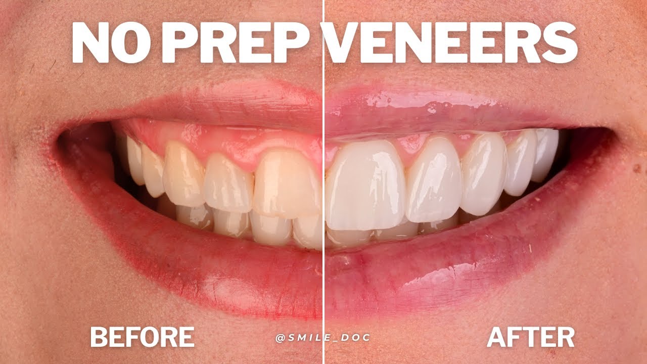 Minimal Preparation Veneers: Full Case Breakdown - YouTube
