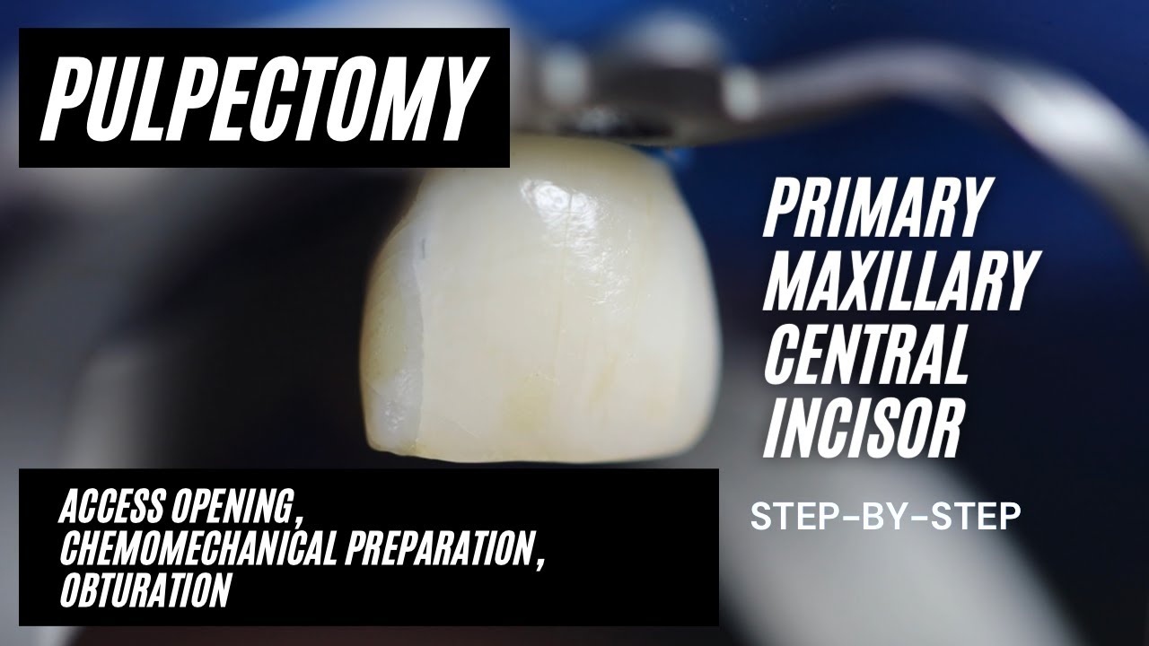 Pulpectomy | primary maxillary central incisor | access opening ...