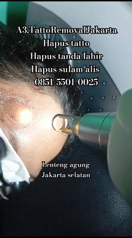 Hapus Tanda Lahir #tattoo #tattooartist #hapustattomurah - YouTube