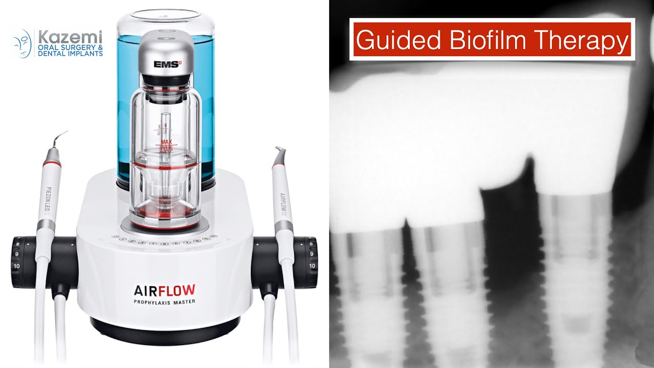 Treatment of Pain & Bleeding Gums Around Dental Implants (Peri ...