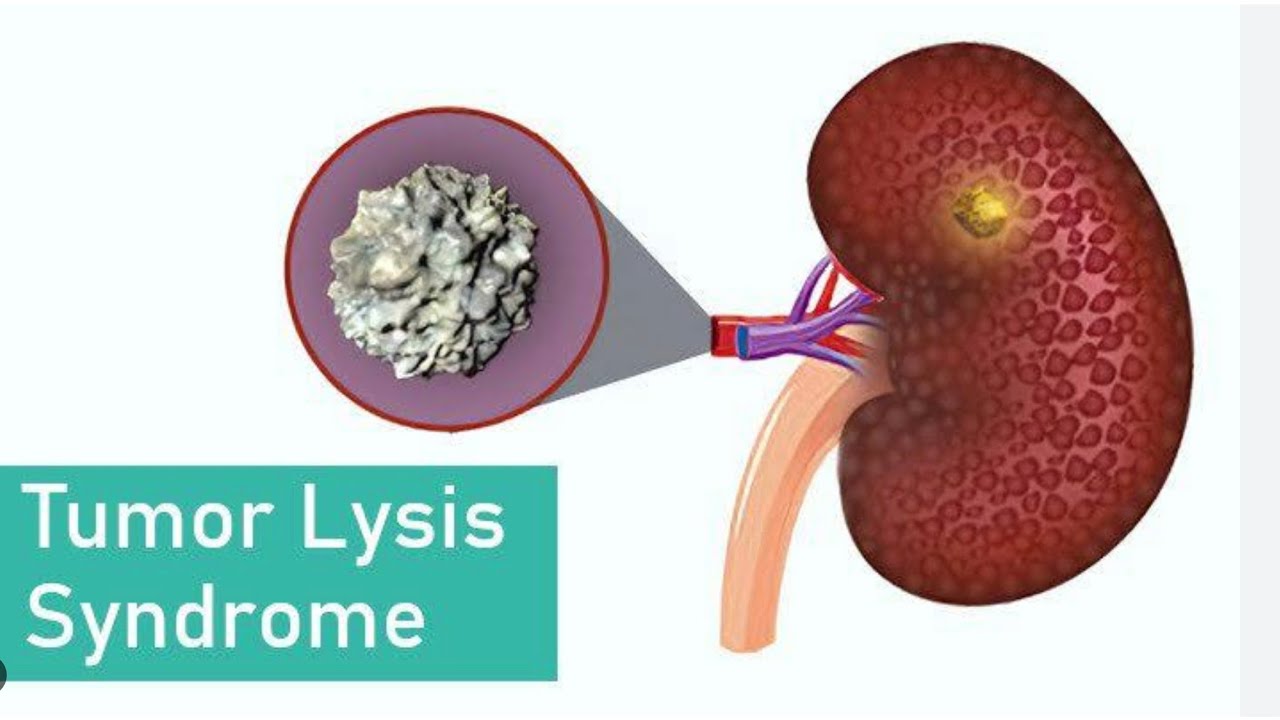 Tumor Lysis Syndrom- Usmle firstaid / Pathoma - YouTube