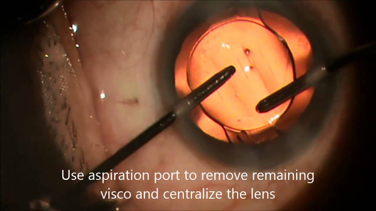 IOL injection technique under BSS - YouTube