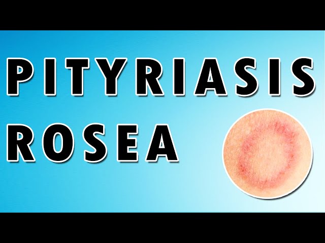 Pityriasis Rosea Herald Patch Healing