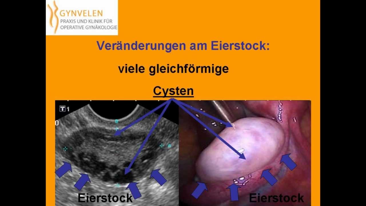 Informationen zum PCO - Syndrom - YouTube