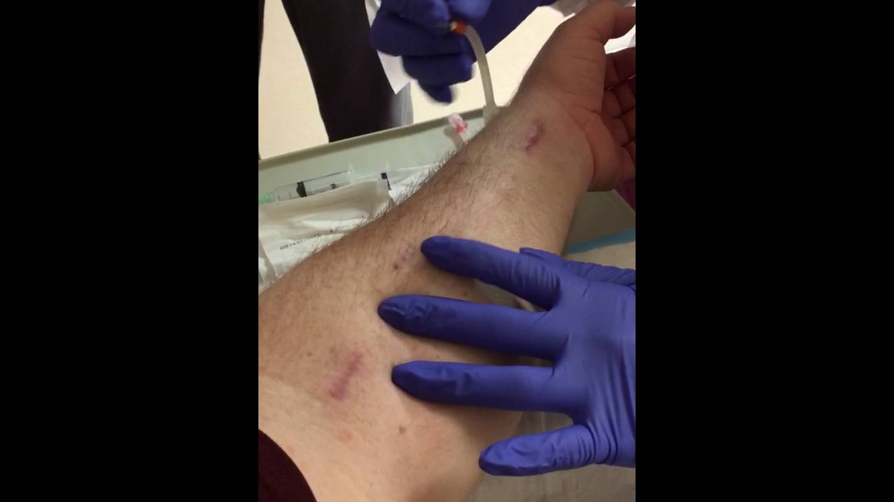 First fistula access - YouTube