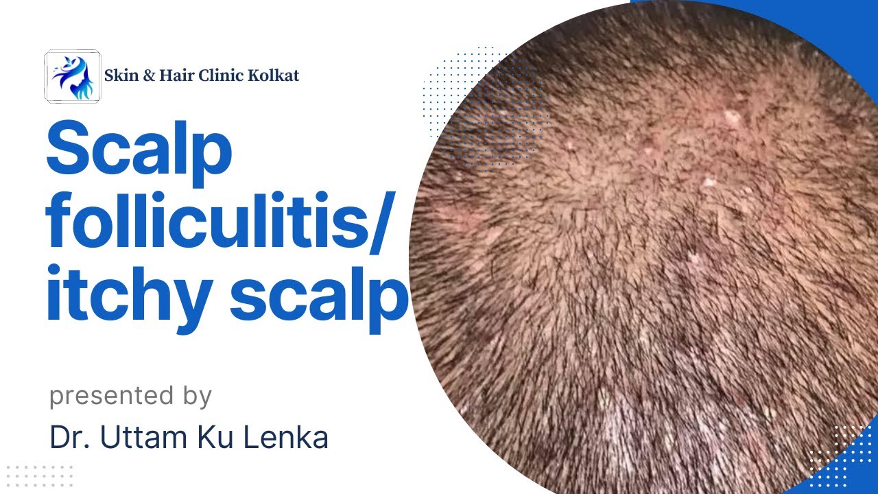 Folliculitis On Scalp