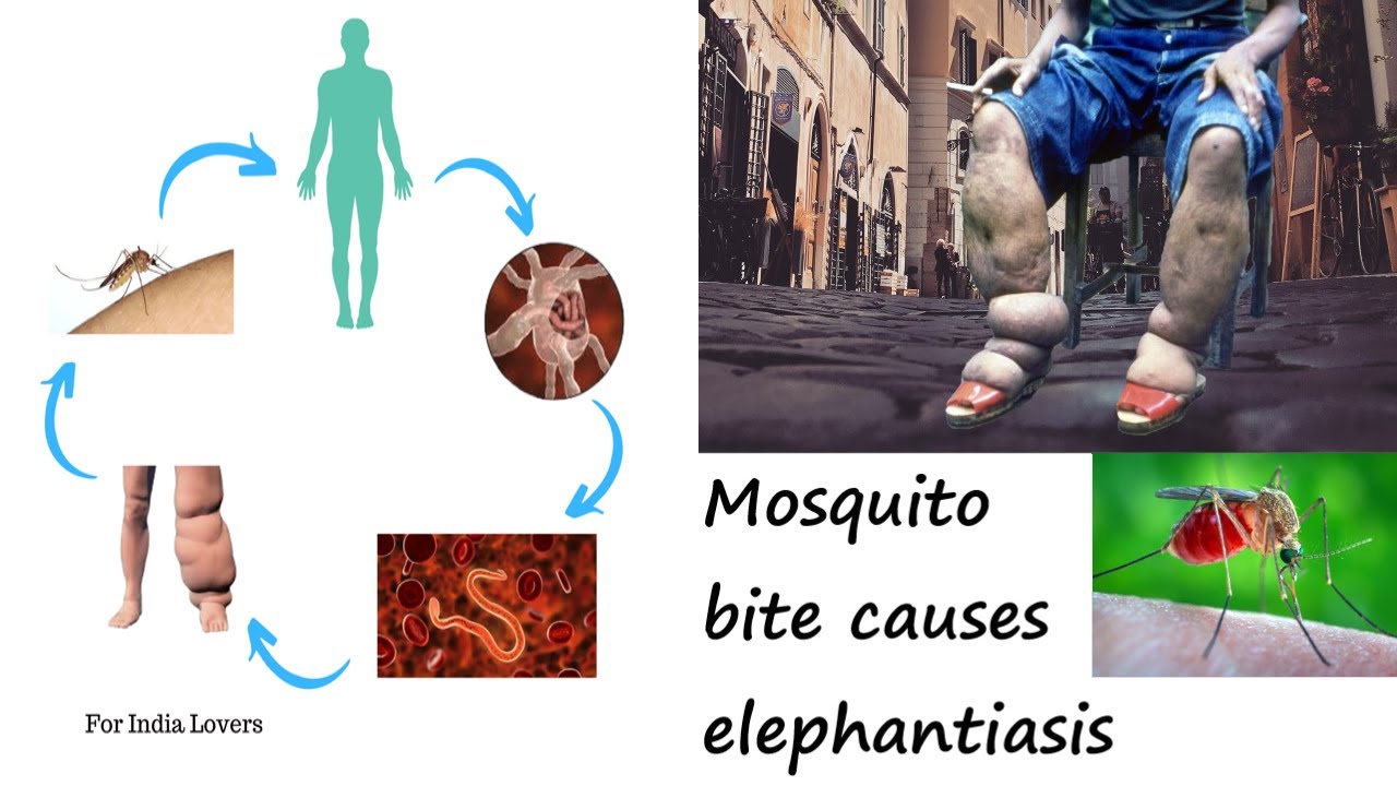 Lymphatic Filariasis / Elephantiasis - Prevalence, Causes, Diagnosis ...