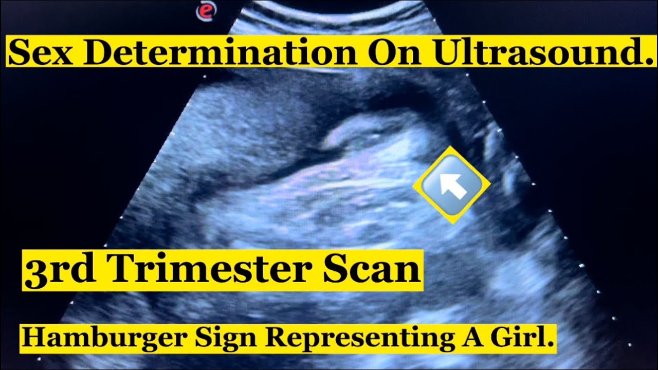 Hamburger Sign Ultrasound