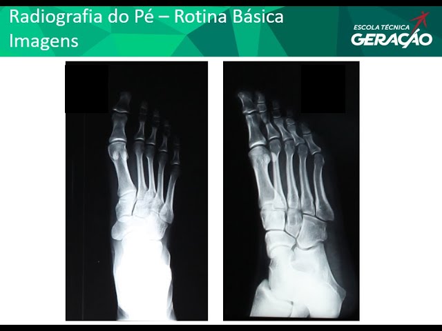 Radiografia Normal Do Pe Lateral Escolha Certa Em Inspeção: