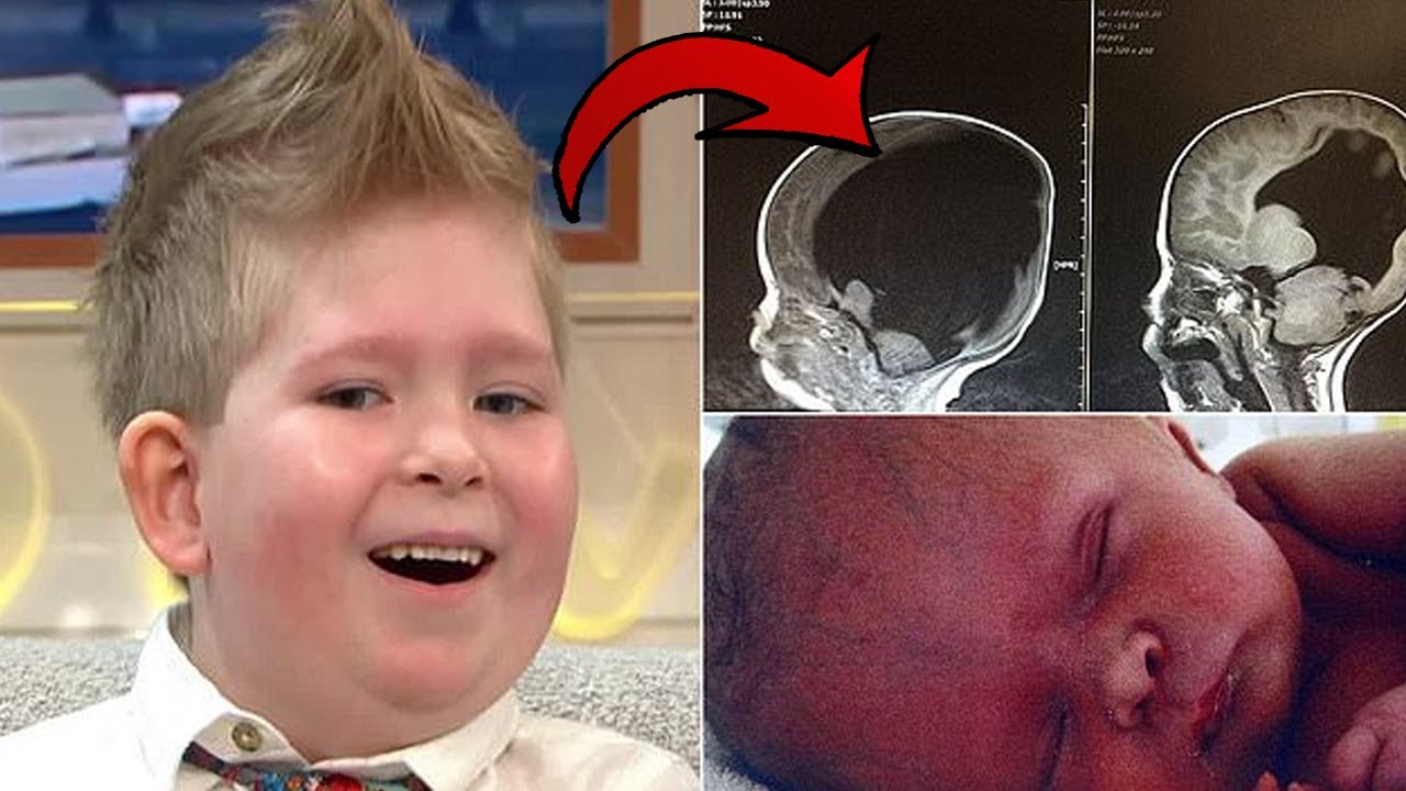 Baby Was Born Without a Brain, But 2 Years Later Doctors Discovered ...