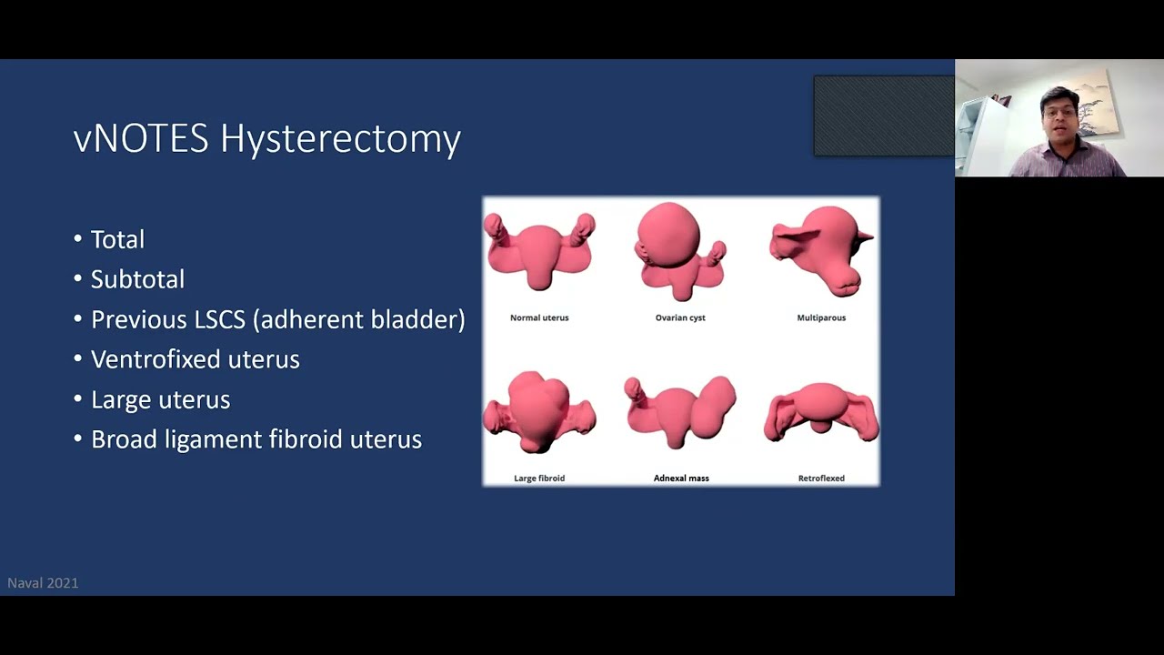 vNOTES Hysterectomy DGES Congress Lecture by Dr. Suyash Naval - YouTube