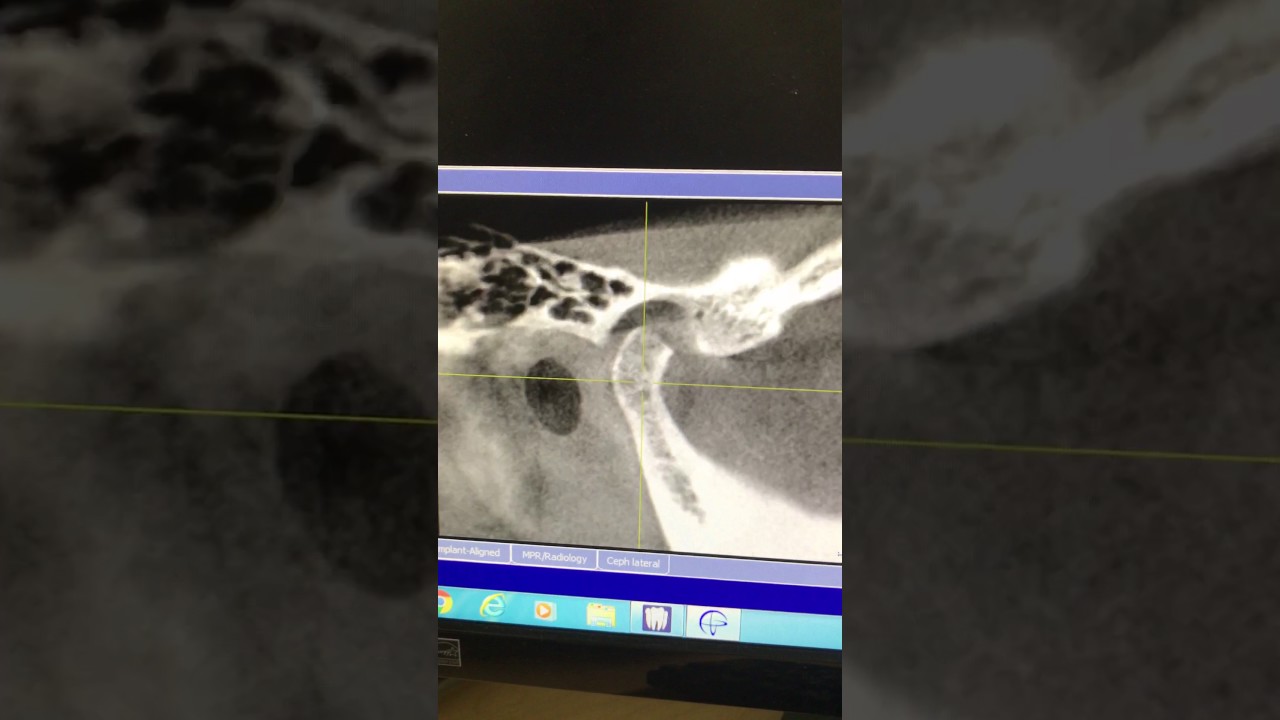 Abnormal TMJ - YouTube