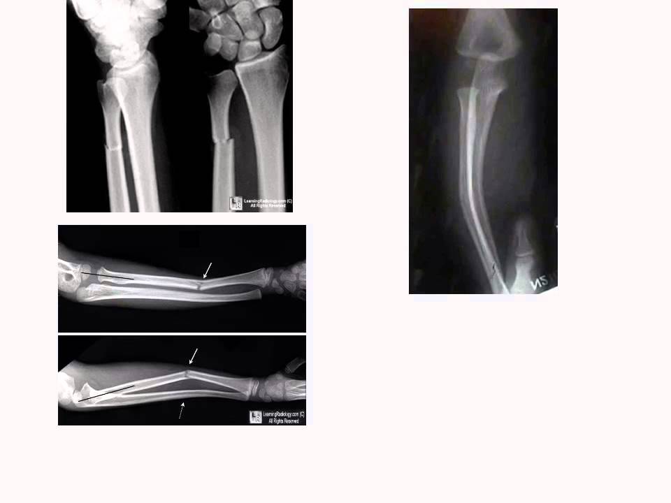 nightstick fracture -ulna- (ulf2) - YouTube