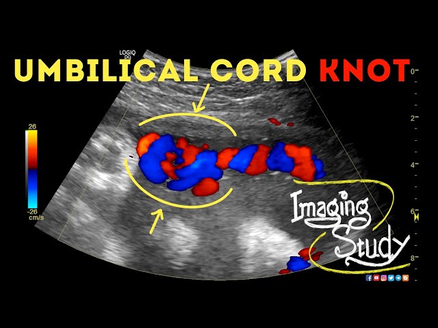 True Knot Umbilical Cord Complications