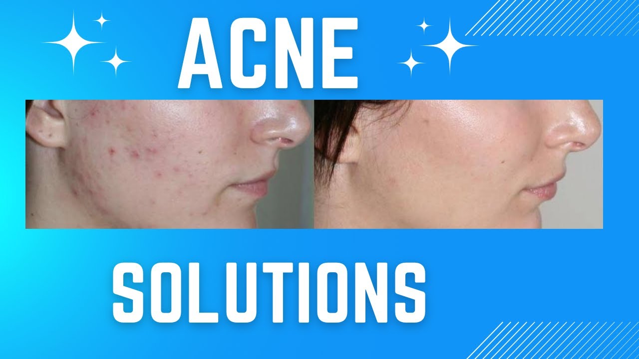 Say Goodbye to Acne: Proven Solutions that Work - YouTube