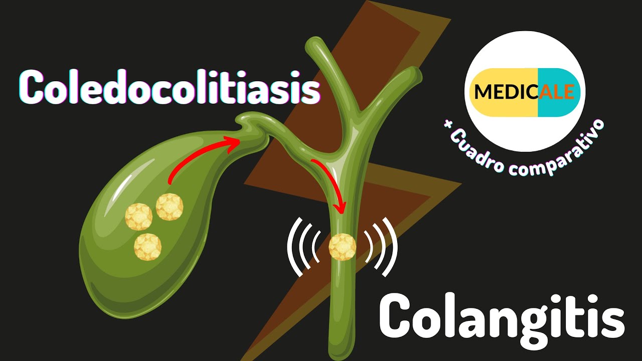 COLEDOCOLITIASIS Y COLANGITIS - CUADRO COMPARATIVO - YouTube