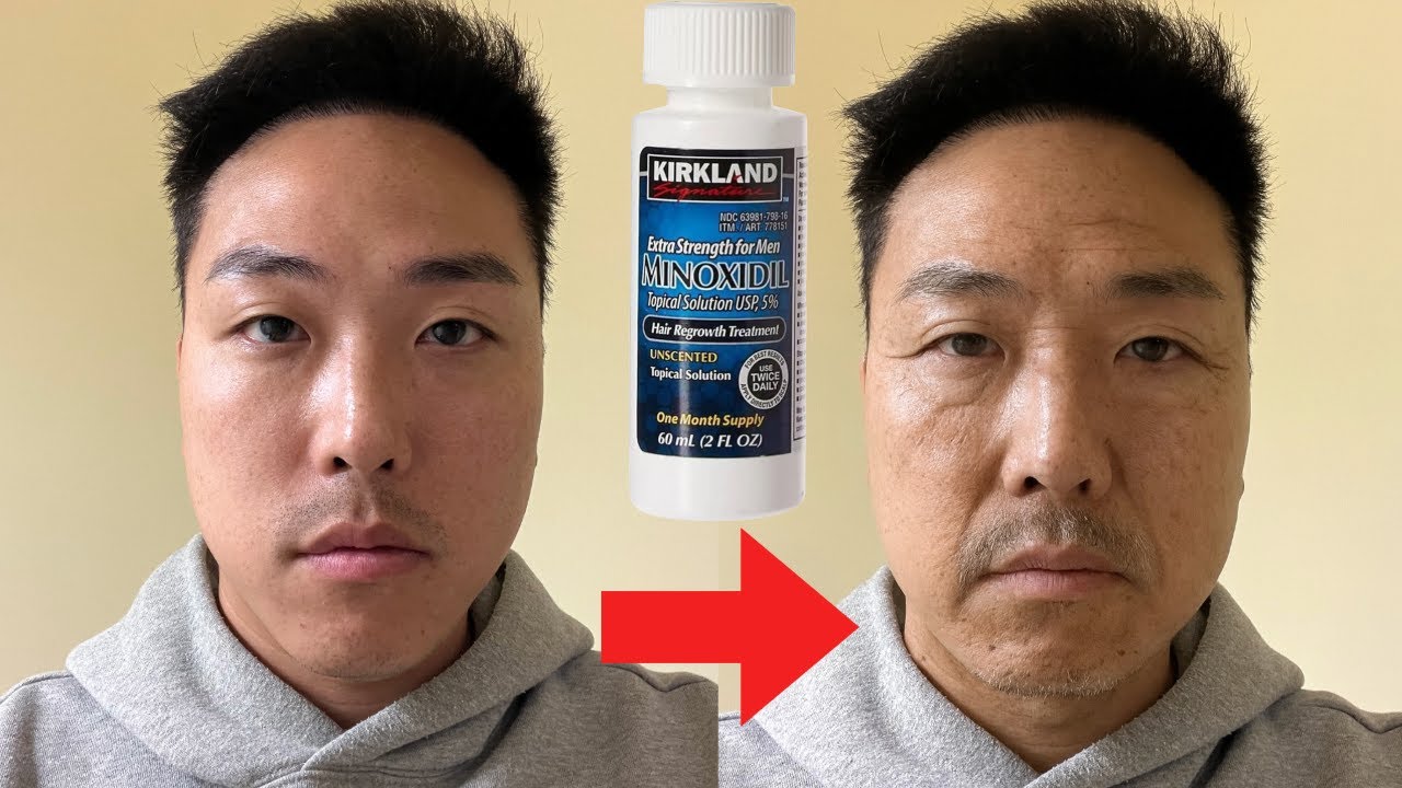 DOES MINOXIDIL CAUSE SKIN AGING AND WRINKLES? - YouTube