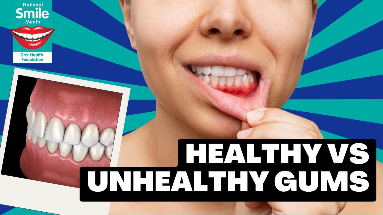 Healthy Gums Vs Unhealthy Gums Healthy Gums Vs Unhealthy Gums